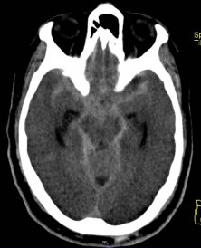 Subarachnoidale bloeding zonder trauma | Medics4medics.com